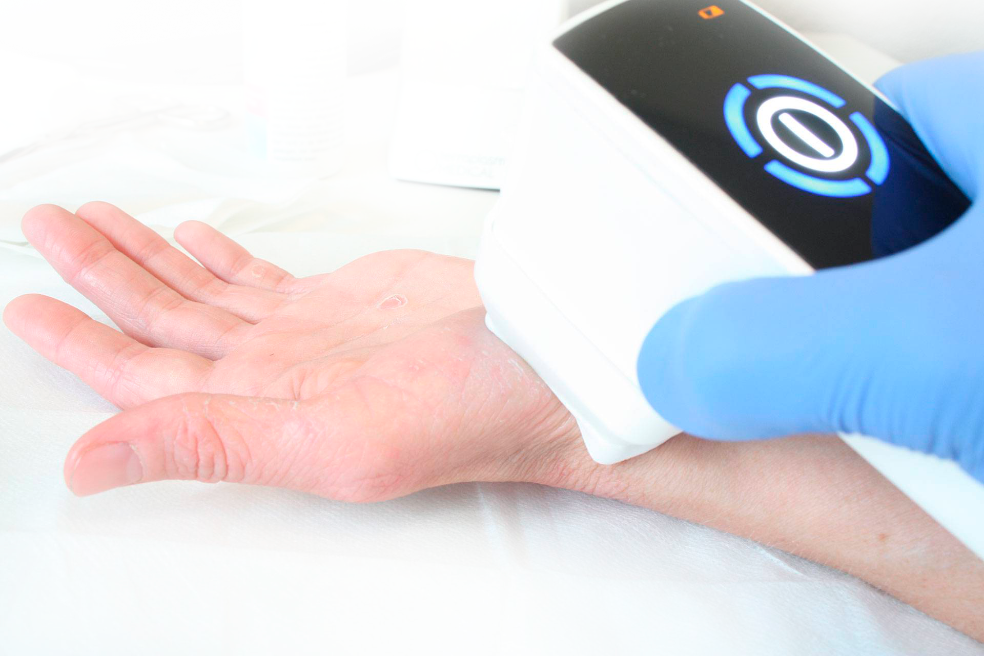 Plasma Care - Plasma frí­o en acción